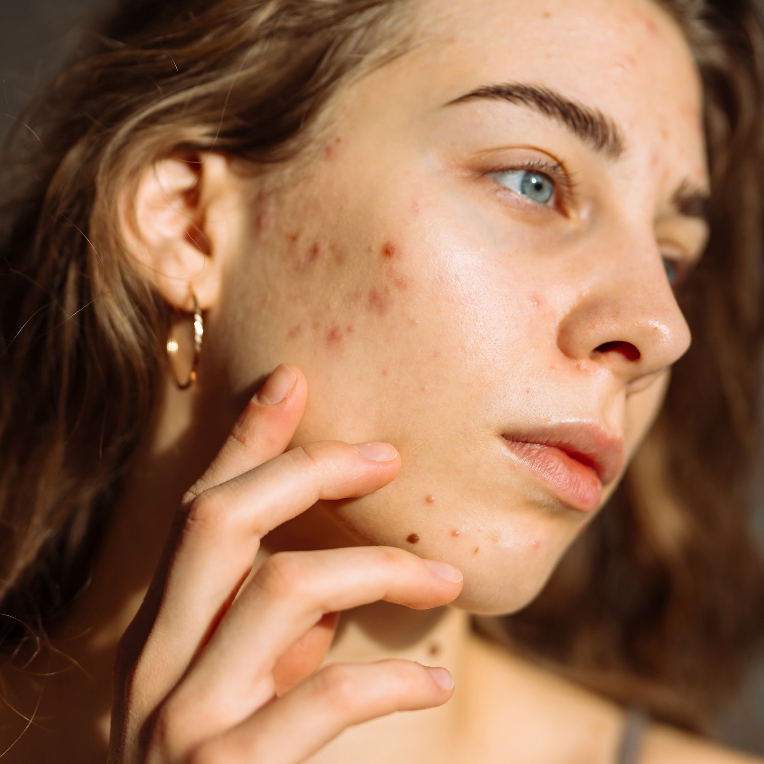 Understanding Acne: More Complex Than Previously Thought - Meder UK
